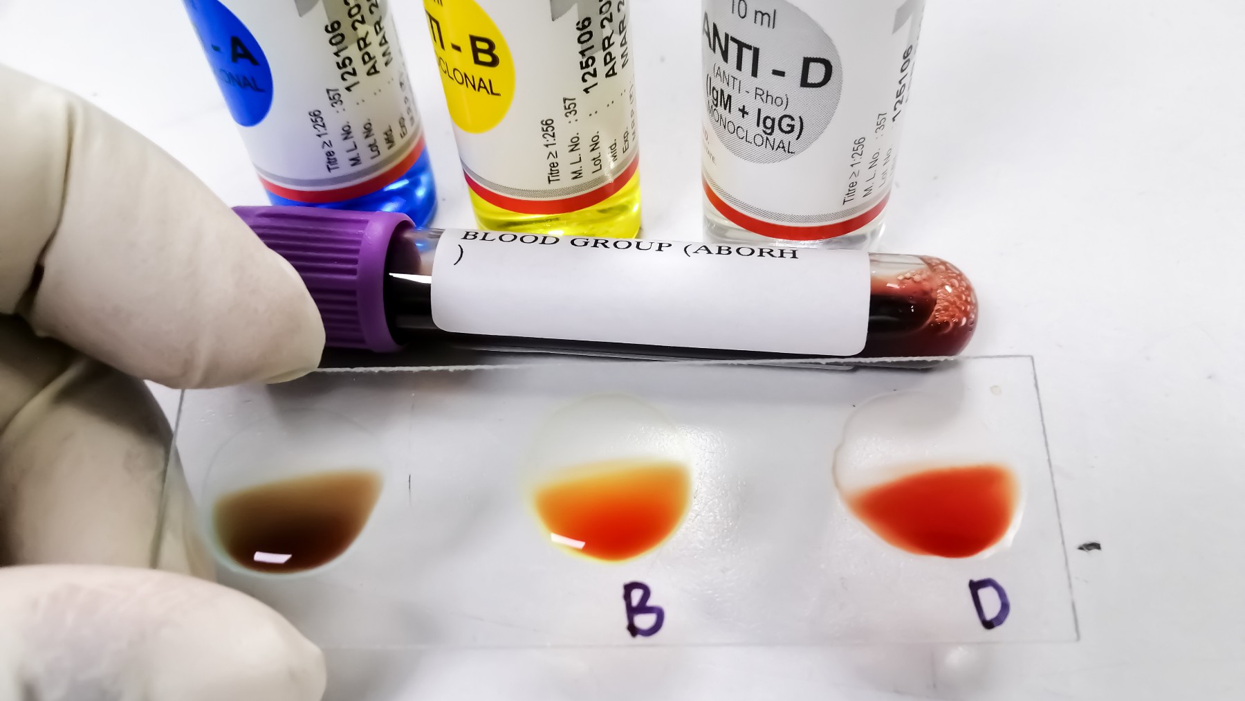 Neither A nor AB - Scientists Discover the MAL Blood Group, Solving a ...